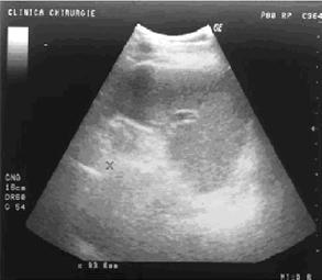 Splenectomia in bolile hematologice – Partea speciala