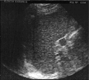 Splenectomia in bolile hematologice – Partea speciala